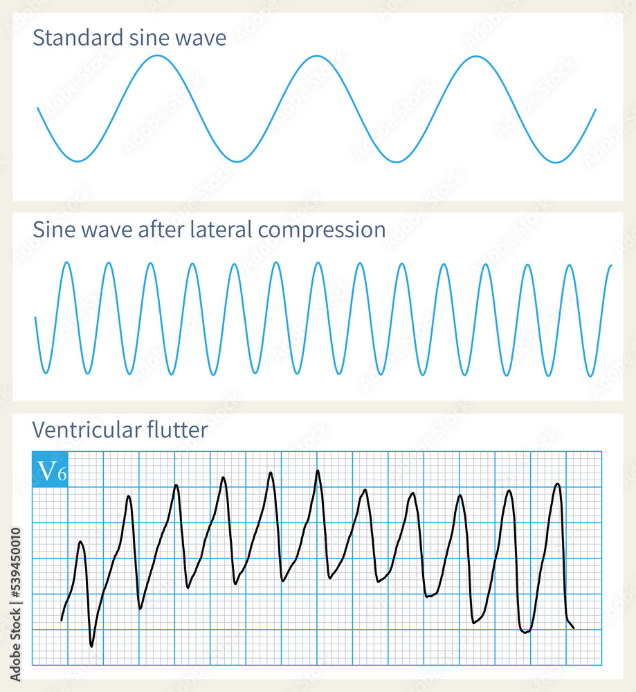 Ventricular flutter is a fatal ventricular tachyarrhythmia, which ...