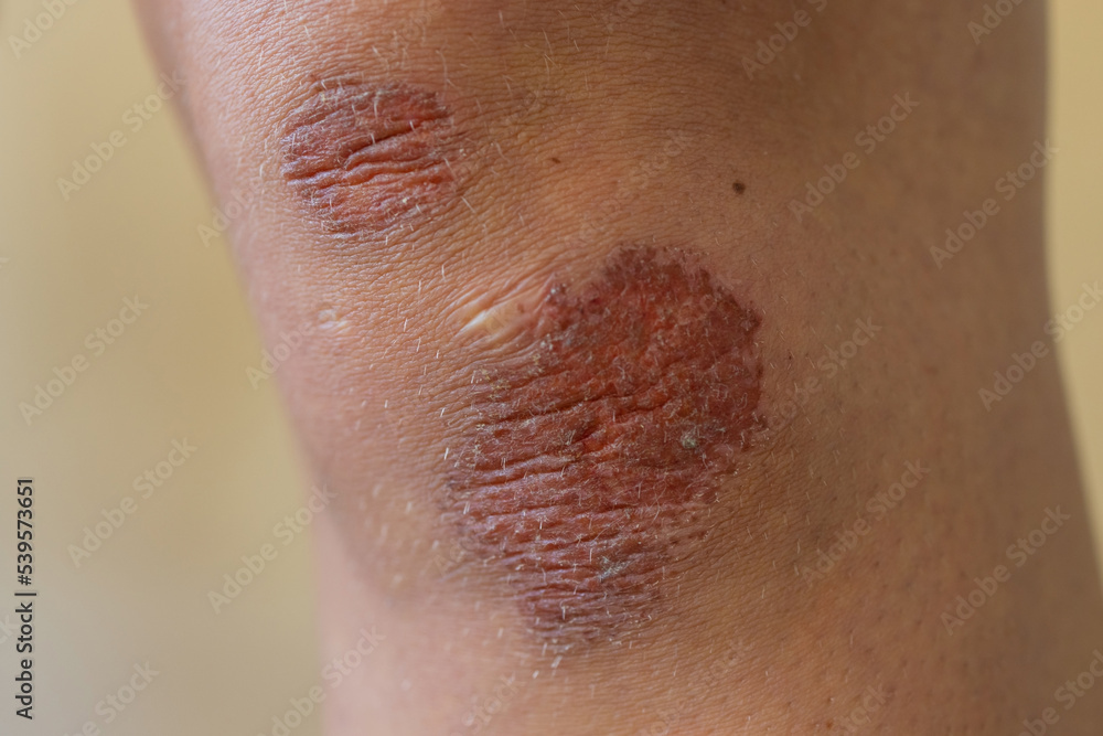 Foto de Abrasion on the woman's knee. Injured leg with a red wound ...