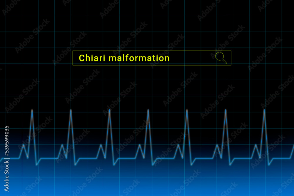 Chiari malformation.Chiari malformation inscription in search bar ...