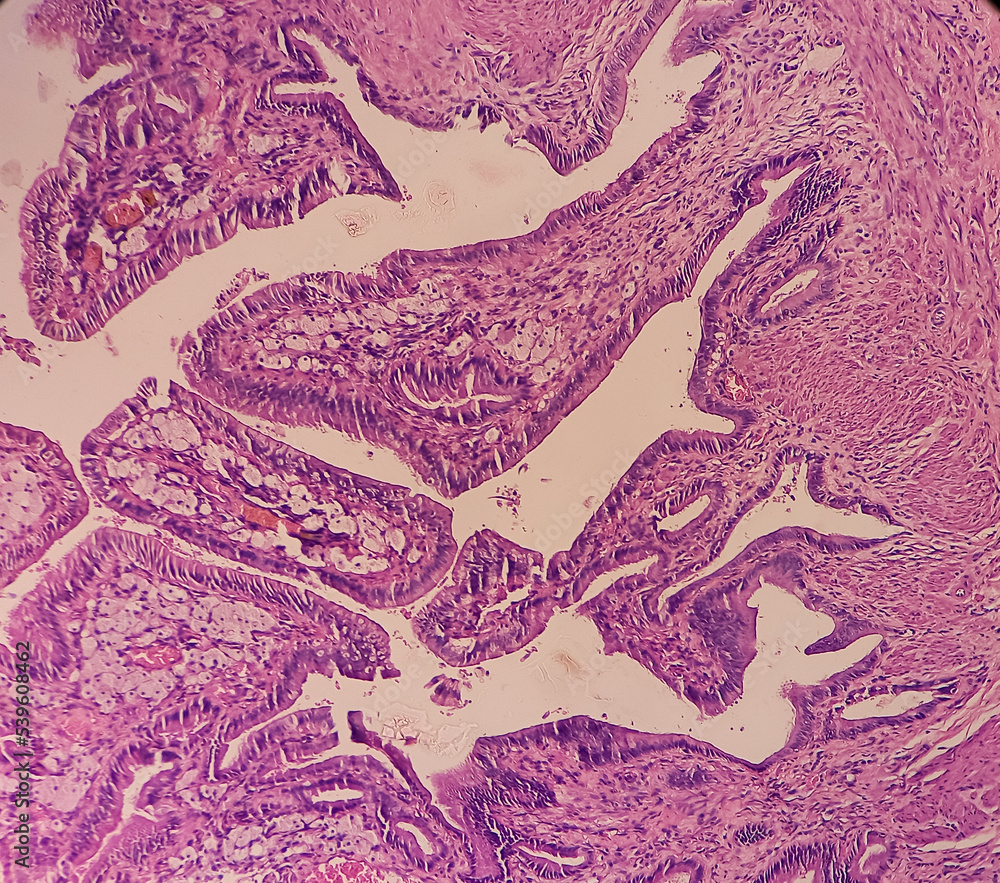 Cholelithiasis of Gallbladder, microphotograph of chronic cholecystitis ...