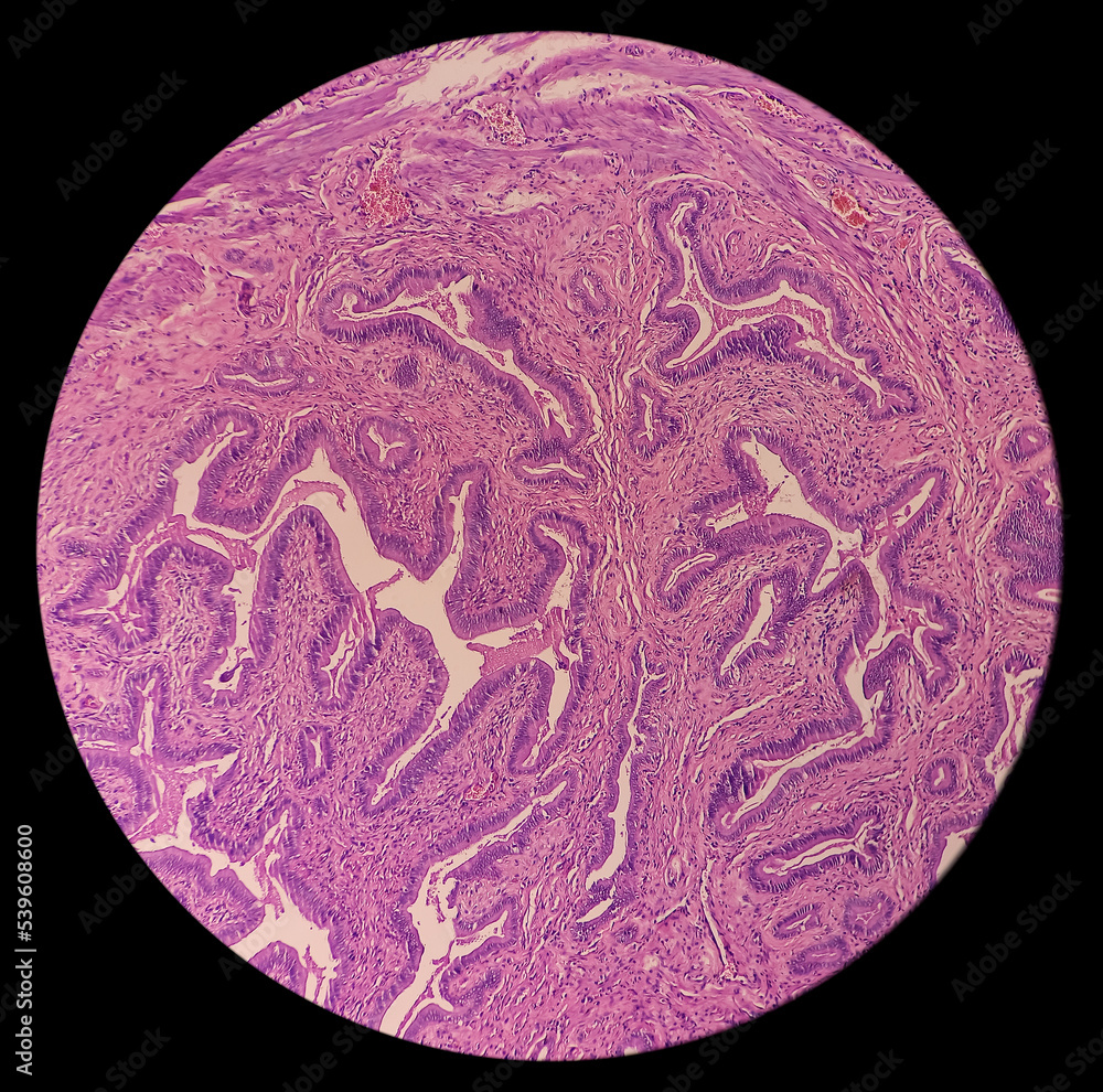 Cholelithiasis of Gallbladder, microphotograph of chronic cholecystitis ...