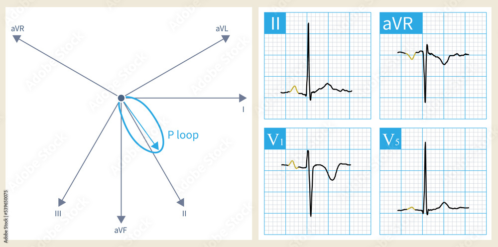 Sinus P wave is usually a smooth low amplitude ECG wave, sometimes with ...
