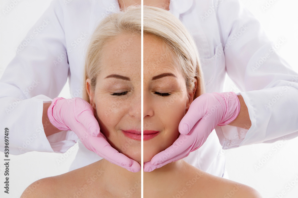 Closeup woman middle age face before after collagen face injection ...