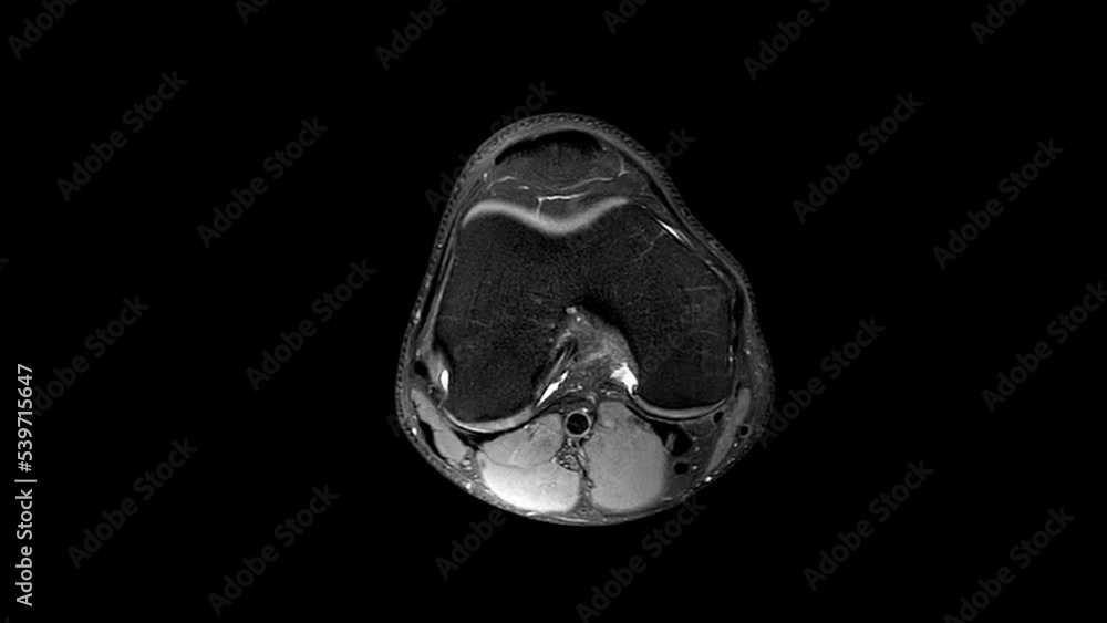 MRI Knee joint or Magnetic resonance imaging for detect tear or sprain ...