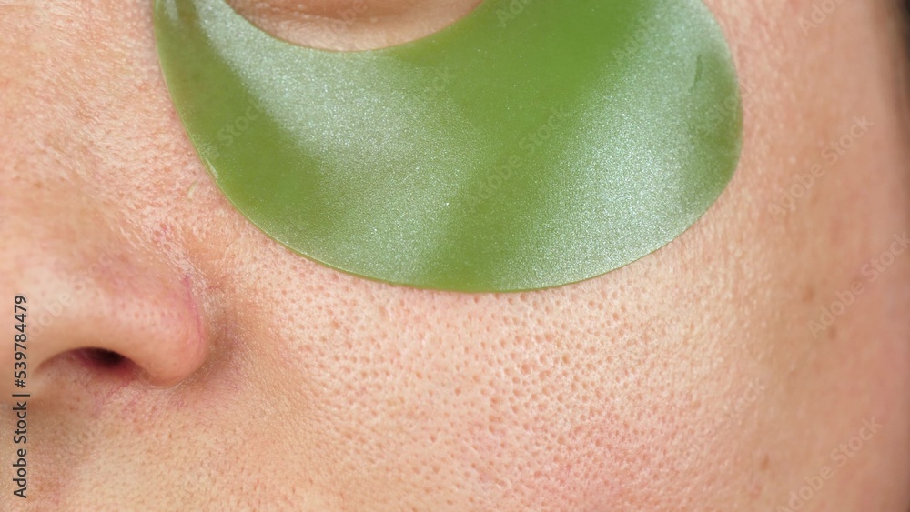 Cosmetology patches on the face. Part of the face with enlarged pores ...