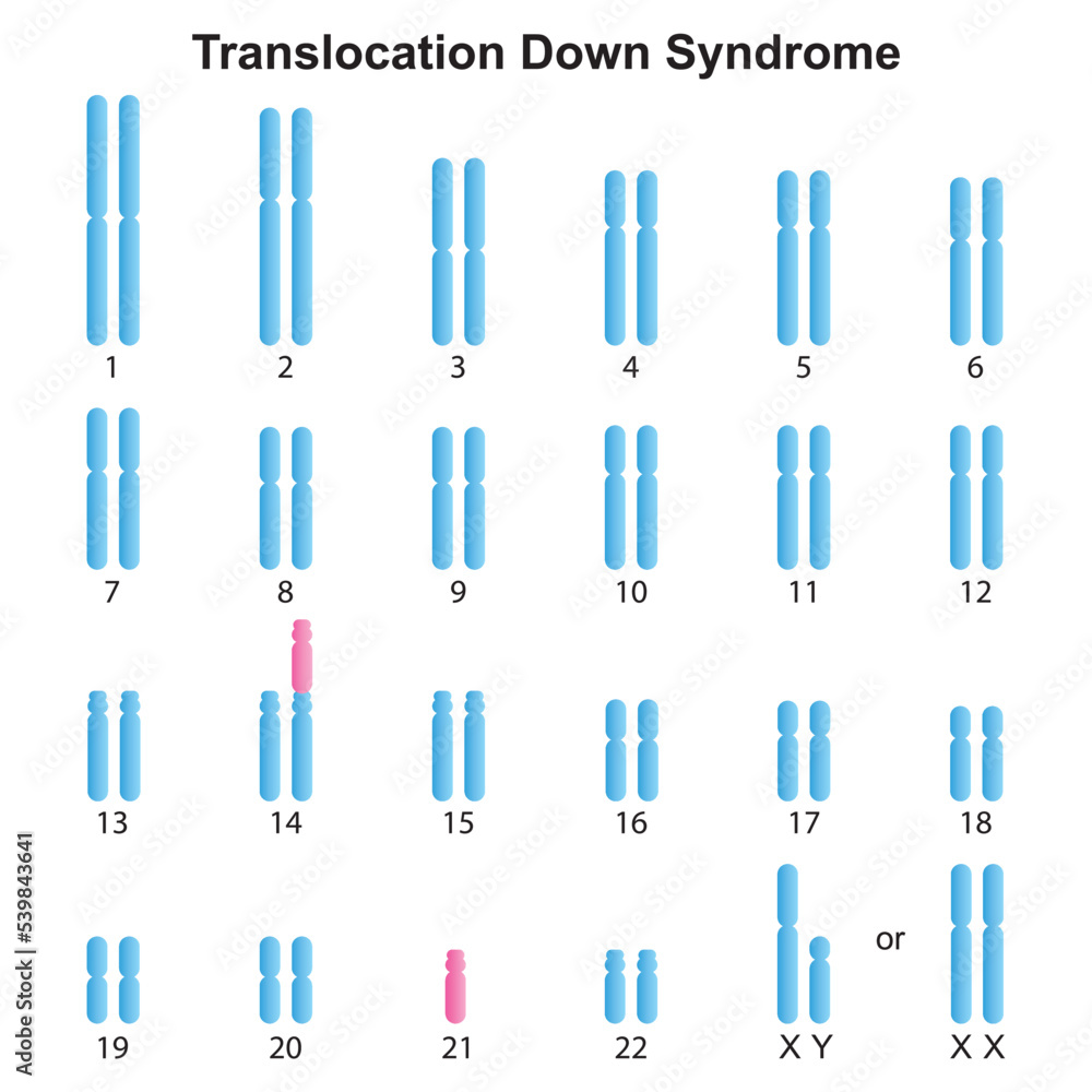 Robertsonian Translocation Karyotype