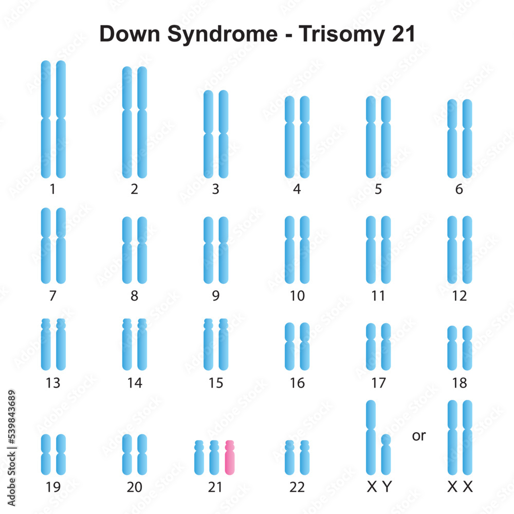 Scientific Designing of Down Syndrome (Trisomy 21) Karyotype. Colorful ... Scientific Designing of Down Syndrome (Trisomy 21) Karyotype. Colorful ...