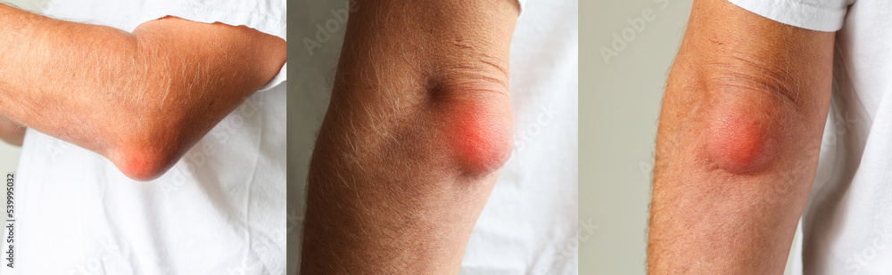 Man swelling erythematous lump pain elbow from Olecranon bursitis ... Man swelling erythematous lump pain elbow from Olecranon bursitis ...