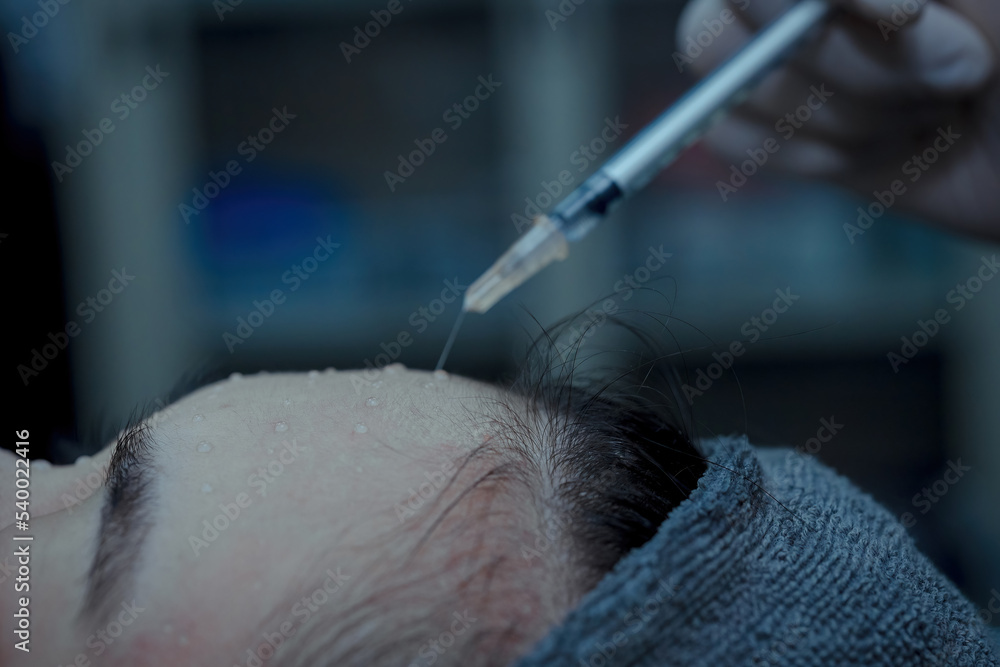 Needle mesotherapy. Microneedle meso therapy, treatment woman at the ...