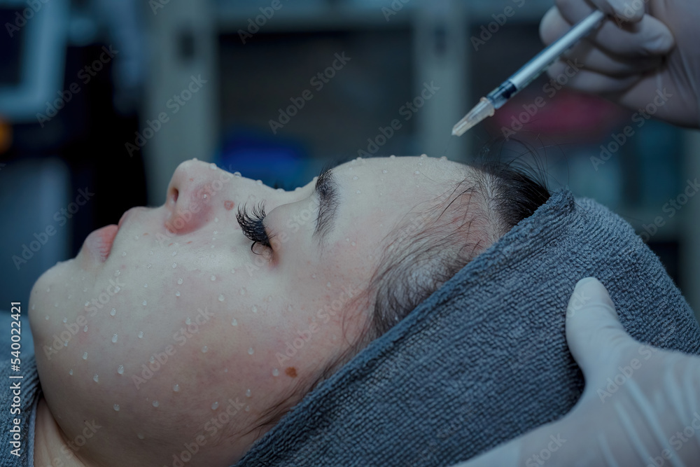 Needle mesotherapy. Microneedle meso therapy, treatment woman at the ...