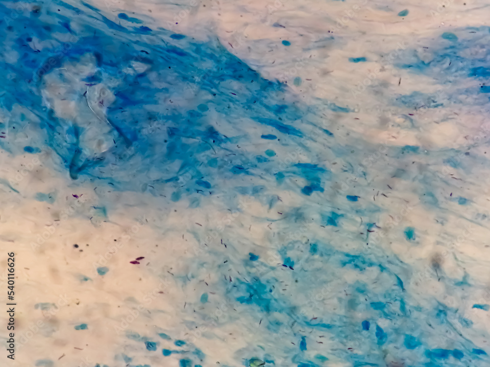 Sputum or phlegm smear AFB stain under microscopy showing ...