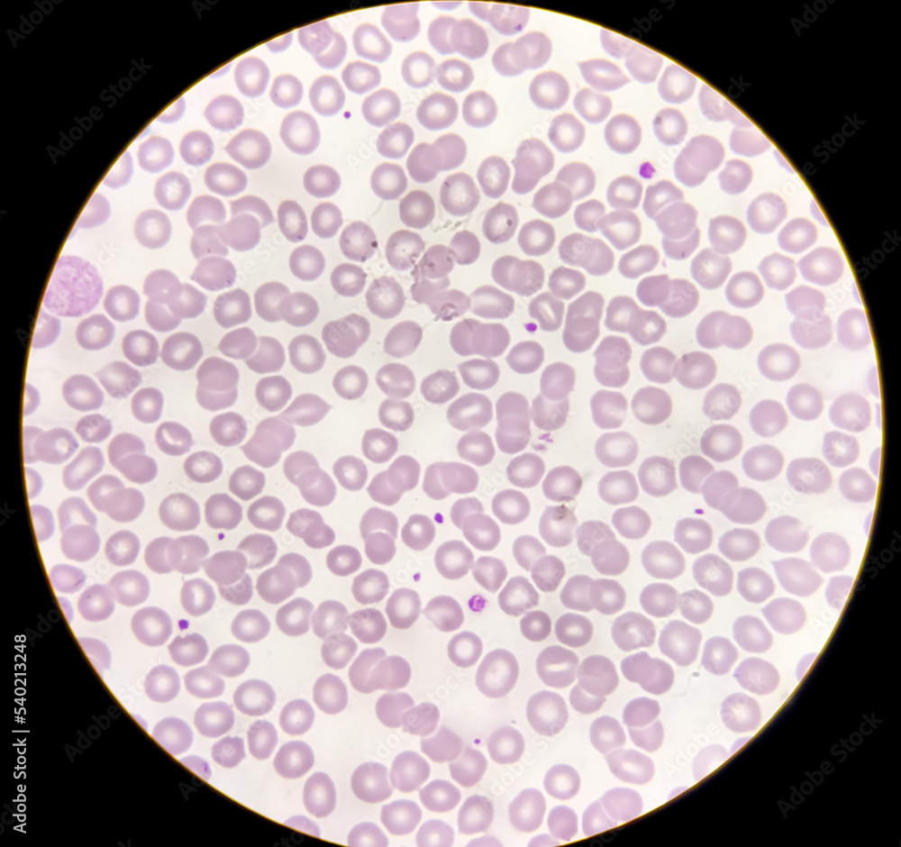 Microscopic view of hematological stained slide. thrombocytopenia ...