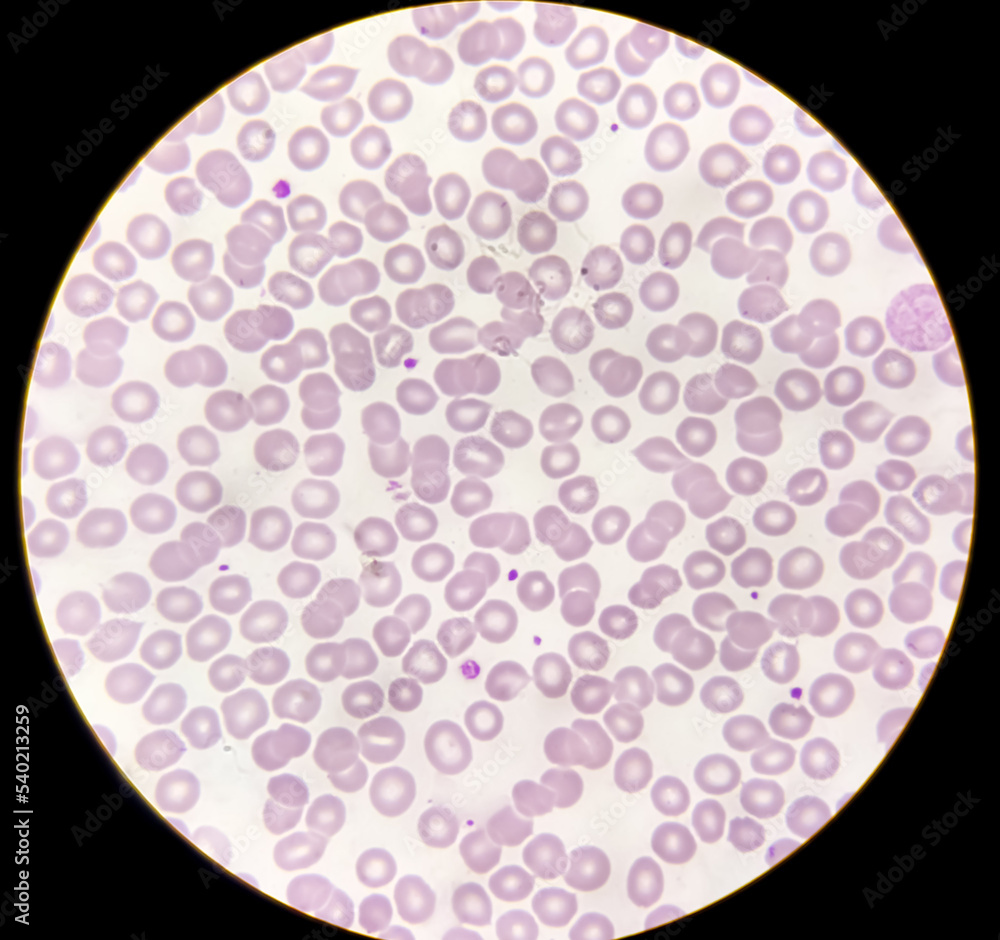 Microscopic view of hematological stained slide. thrombocytopenia ...