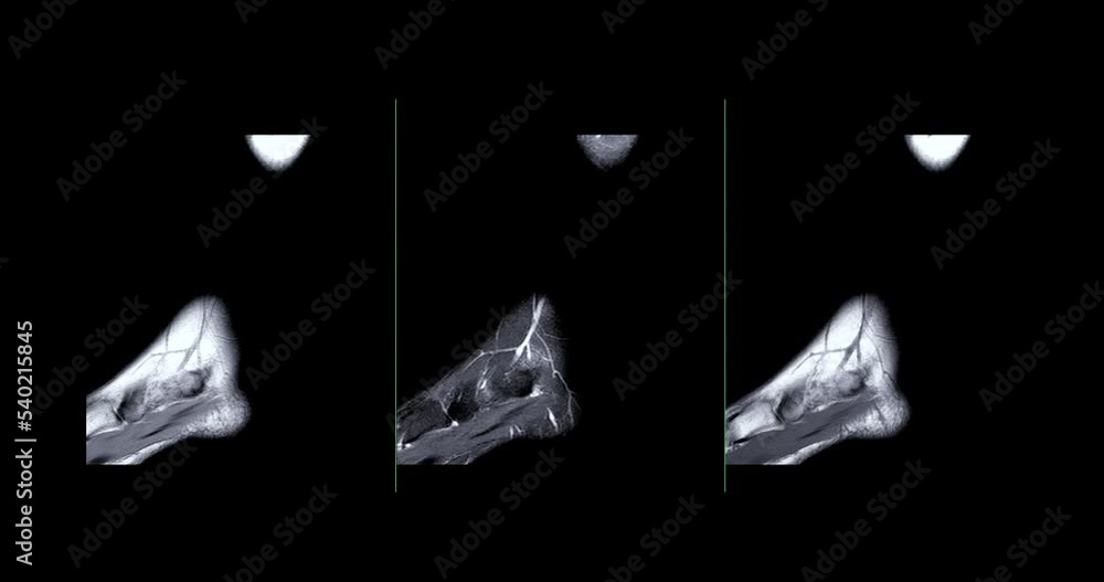 MRI of ankle joint for diagnosis tendon of ankle joint injury from ...