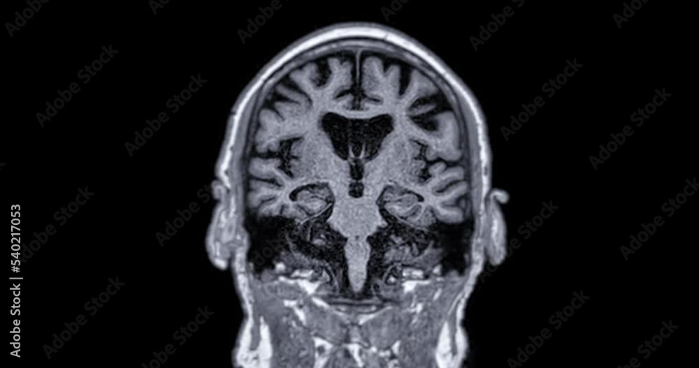 MRI Brain can help doctors look for conditions such as bleeding ...