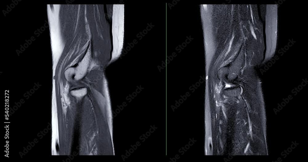 MRI elbow joint for Evaluation of the elbow by magnetic resonance ...
