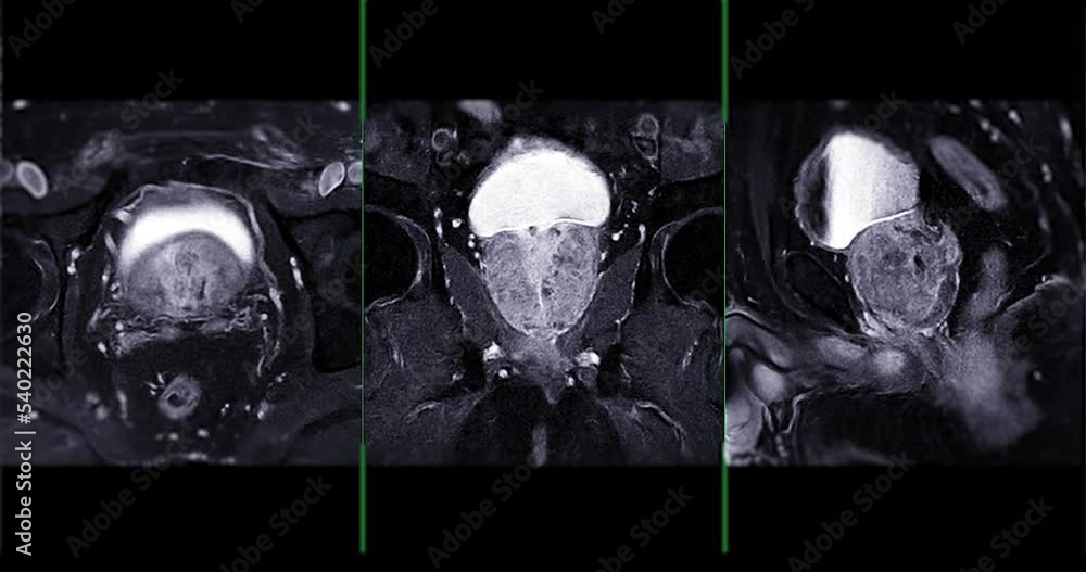 MRI prostate gland for diagnosis prostate cancer cell and evaluate the ...