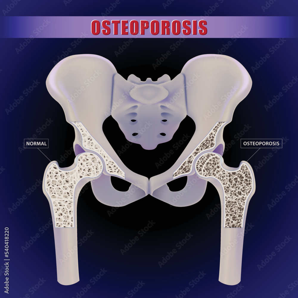 3D illustration of a human hip bone comparing the inside of normal bone ...
