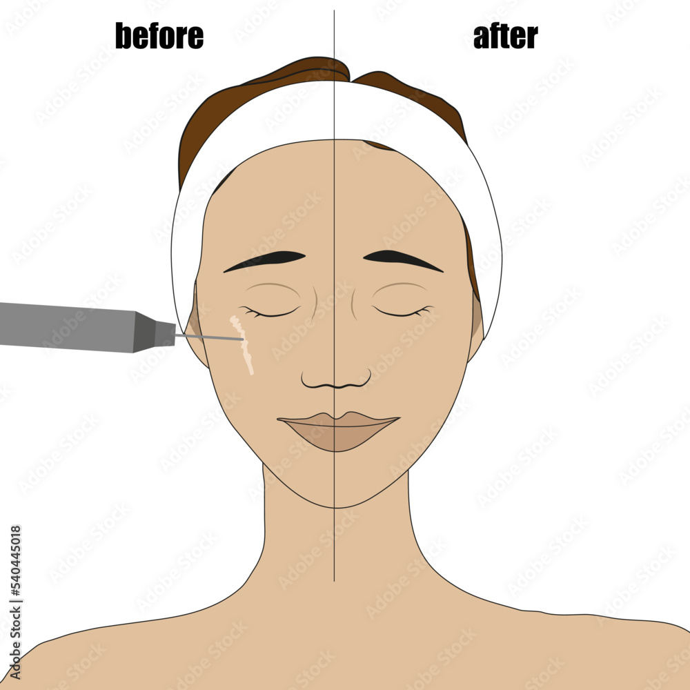 A girl's face in a hairband, a diagram before and after, laser removal ...