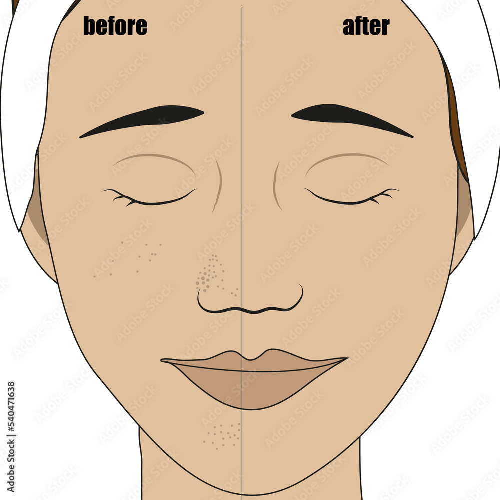 A girl's face with an image of one half of the face with black dots and ...