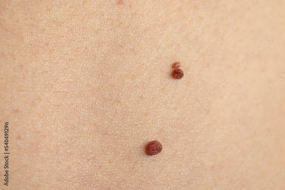 Close-up of large rashes or smallpox on the skin of an adult male ...