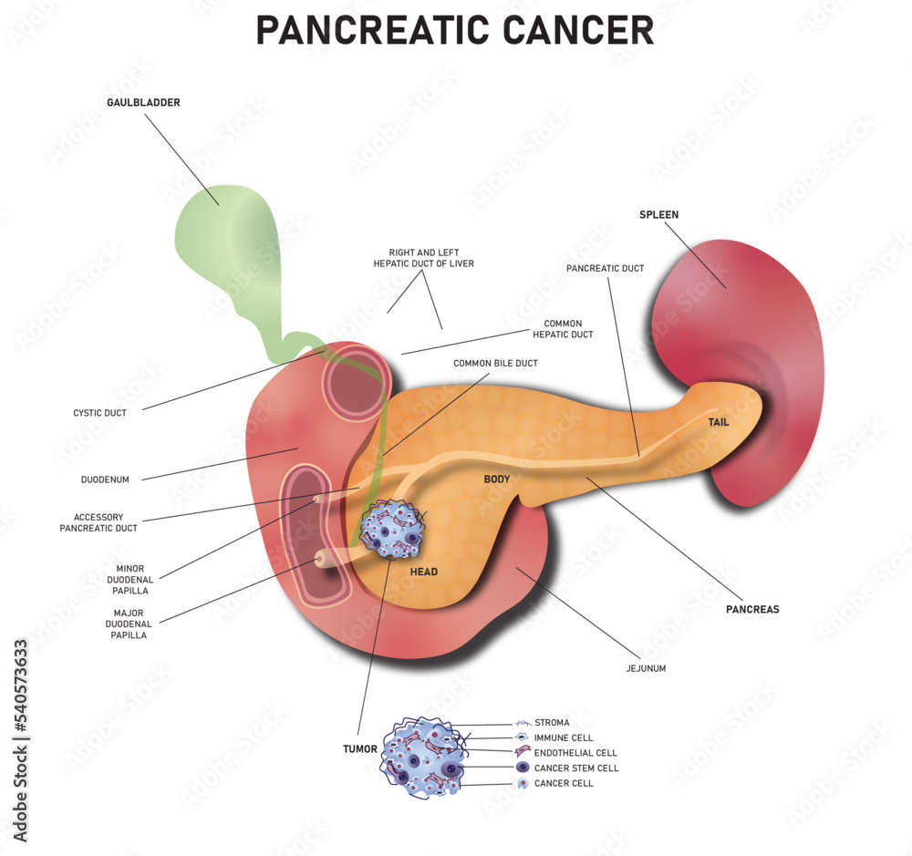PANCREATIC CANCER Stock Vector | Adobe Stock