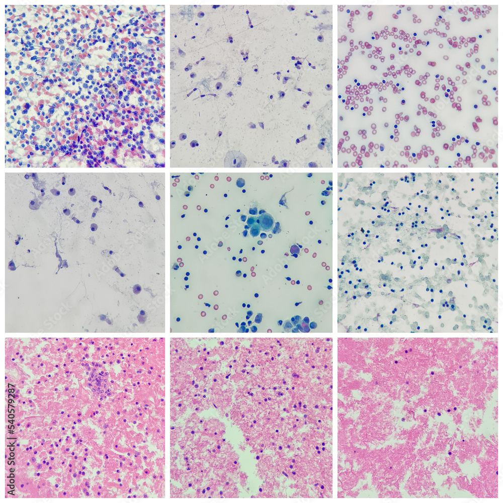 Camera photo of cytology specimen cell block preparation from various ...