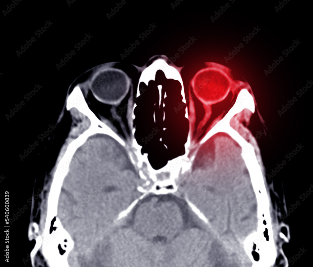 CT scan of the brain sagittal view for diagnosis brain tumor,stroke diseases and vascular ...