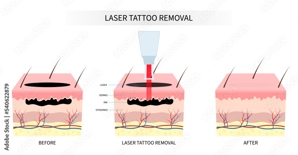 skin tattoo remove surgery Stock Vector | Adobe Stock