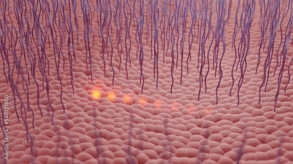 HIFU laser treatment, Laser light shot through skin cell to SMAS ...