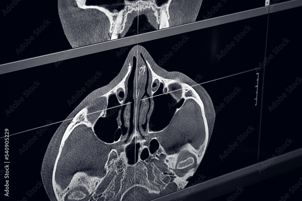 computed tomography (CT) scan of the nasal septum, skull bones Stock ...