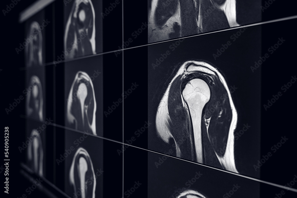 MRI Scan, Magnetic Resonance Images of the shoulder joint Stock Photo ...