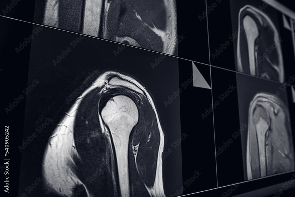 MRI Scan, Magnetic Resonance Images of the shoulder joint Stock Photo ...