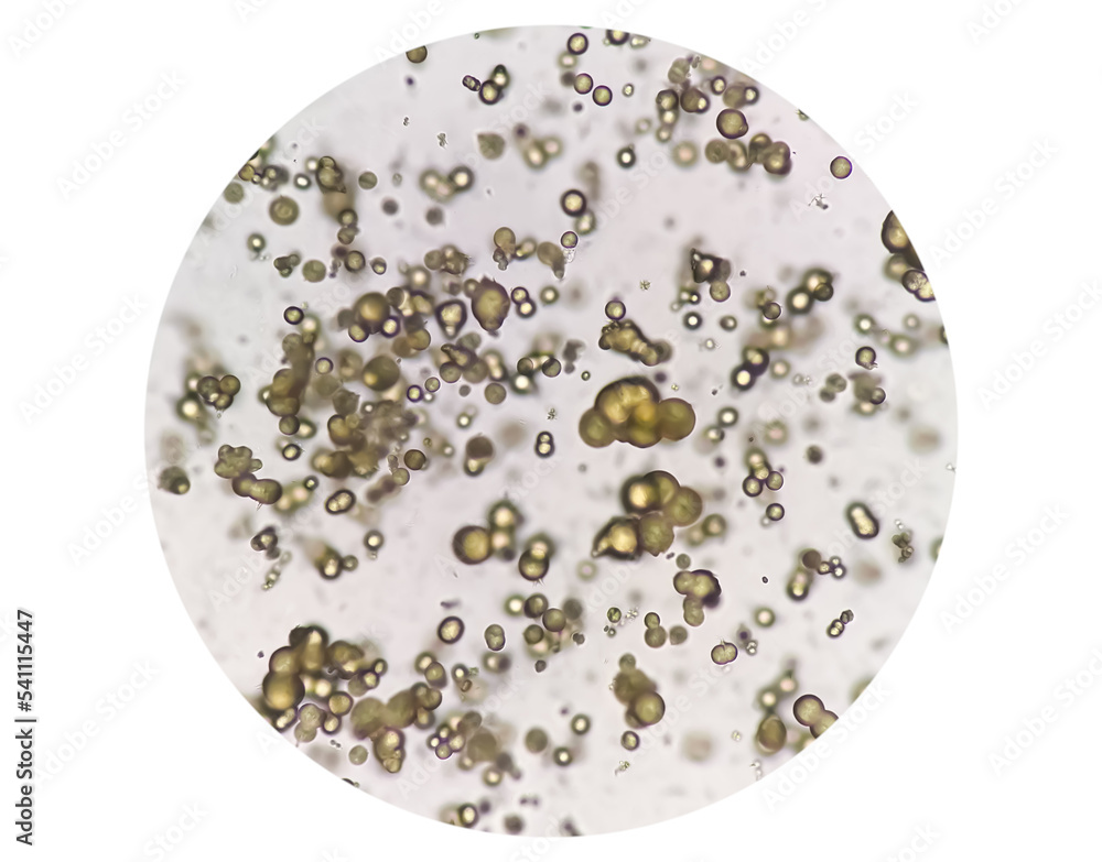 Microscopic image of Urinalysis. Abnormal urine exam. Uric acid ...
