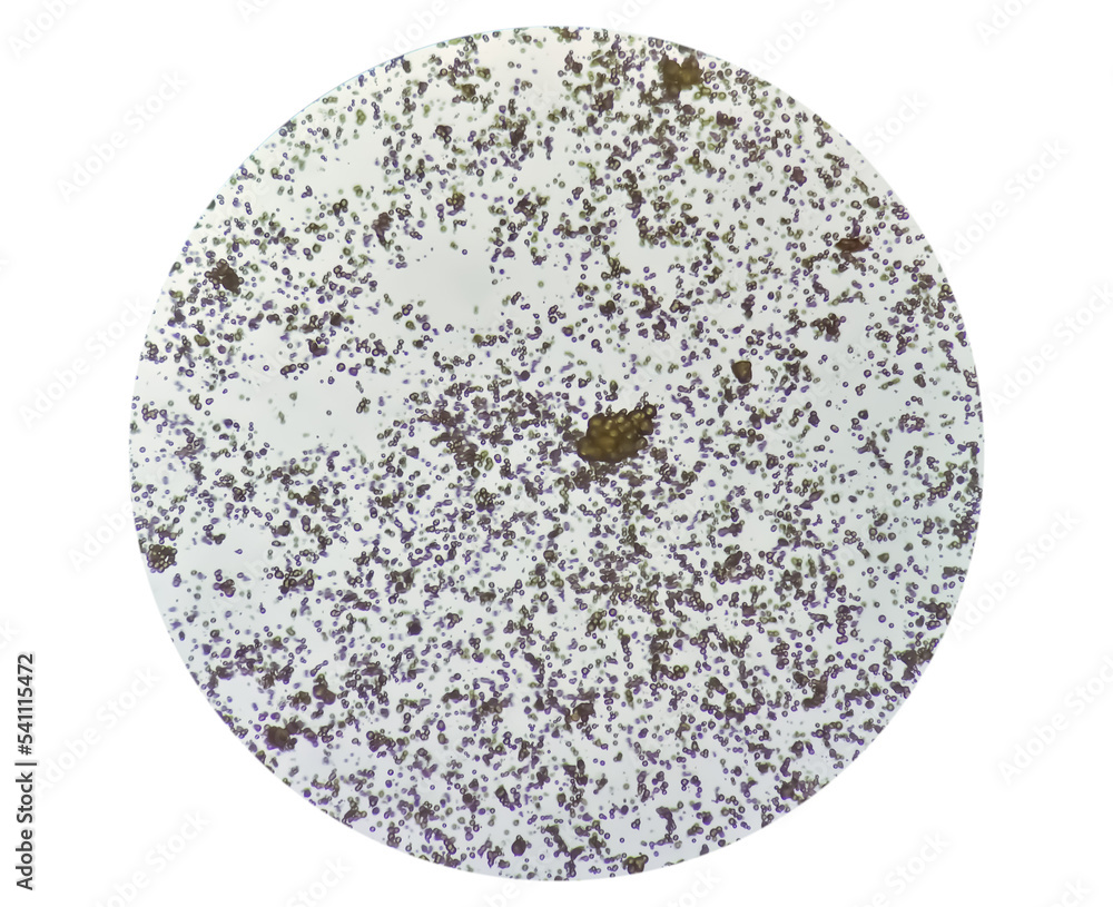 Microscopic image of Urinalysis. Abnormal urine exam. Uric acid ...