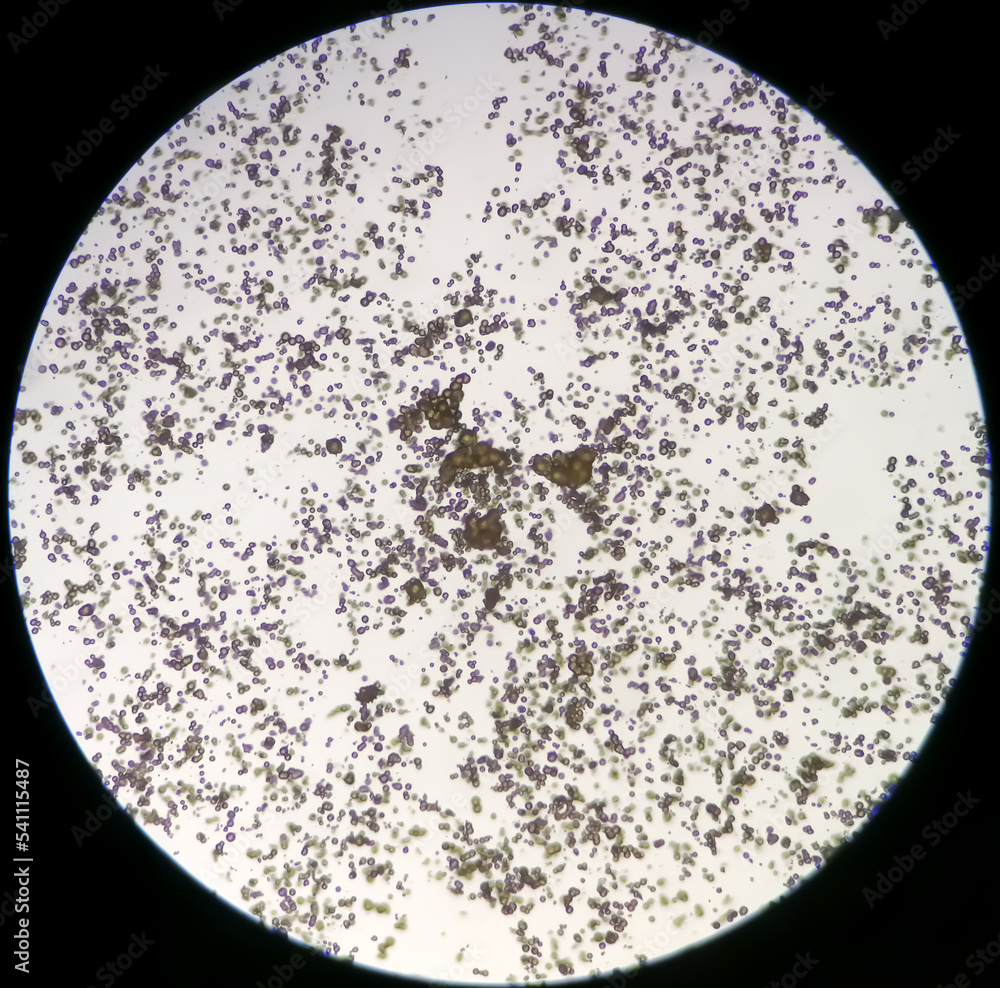 Microscopic image of Urinalysis. Abnormal urine exam. Uric acid ...