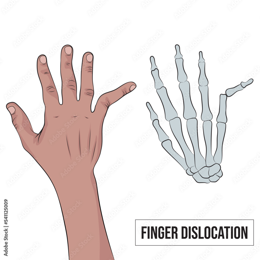 Fractured finger right hand, hand bones x-ray. Stock-Vektorgrafik ...
