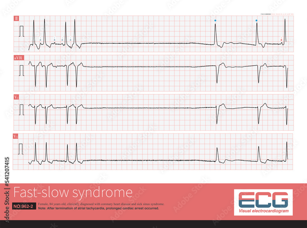 After termination of atrial tachycardia, there is a prolonged sinus ...