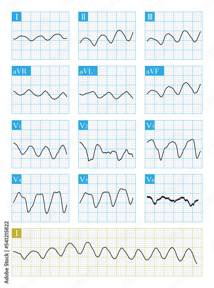 Ventricular flutter is a fatal fast ventricular arrhythmia. The ECG ...