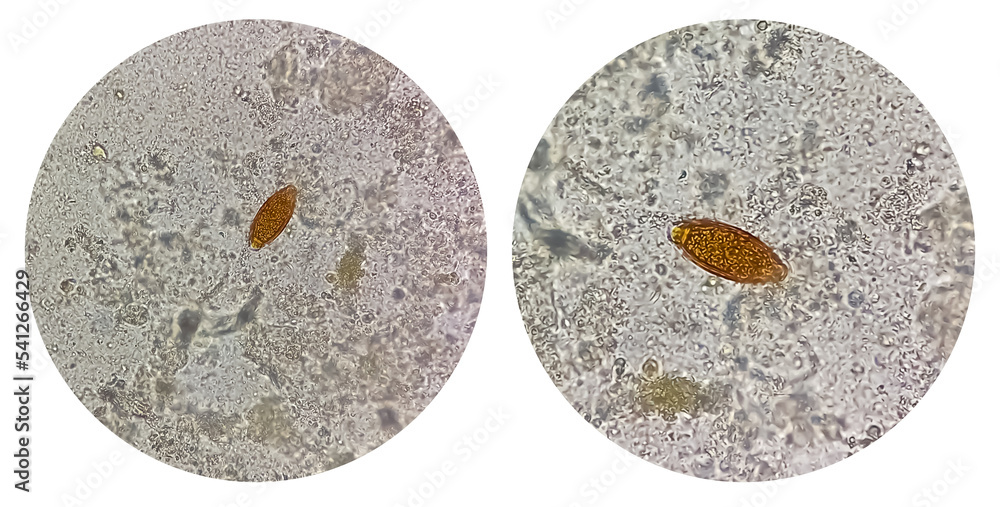 Photo collage of Trichuris trichiura ova (whipworm) in stool, analyze ...