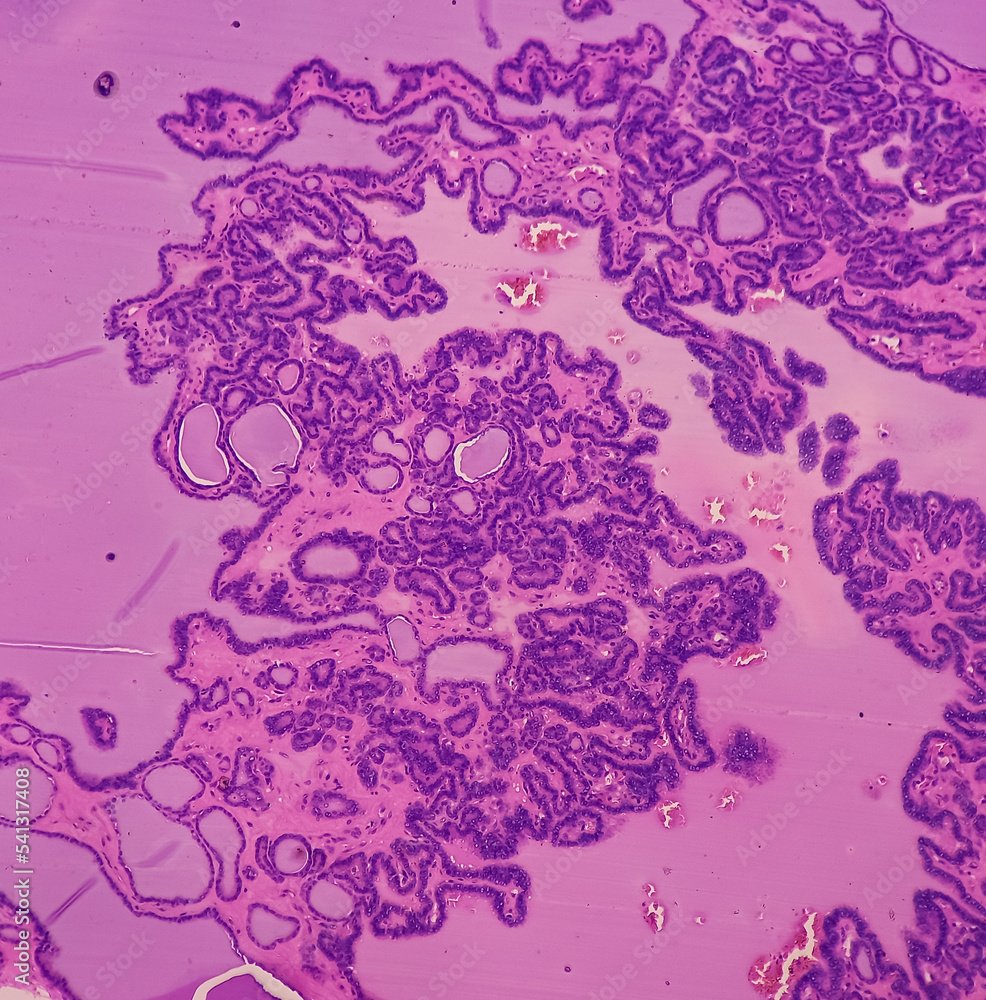 Multinodular goitre. Show thyroid tissue, follicles of different size ...