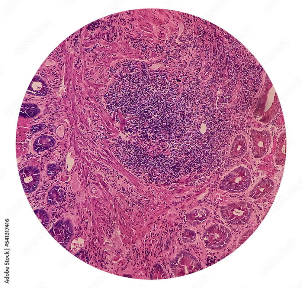 Photo Anal canal ulcer biopsy: Chronic nonspecific proctitis, show anal ...