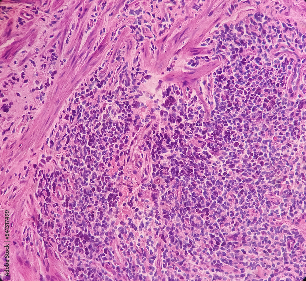 Foto de Anal canal ulcer biopsy: Chronic nonspecific proctitis, show ...
