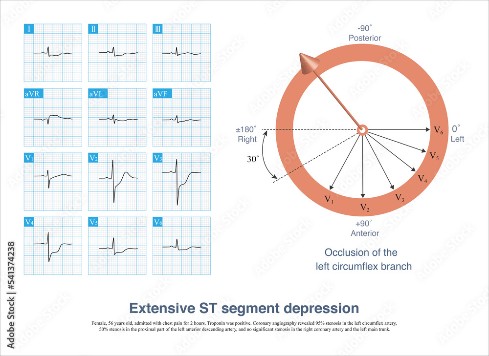 In the case of extensive ST segment depression, the culprit vessels are ...