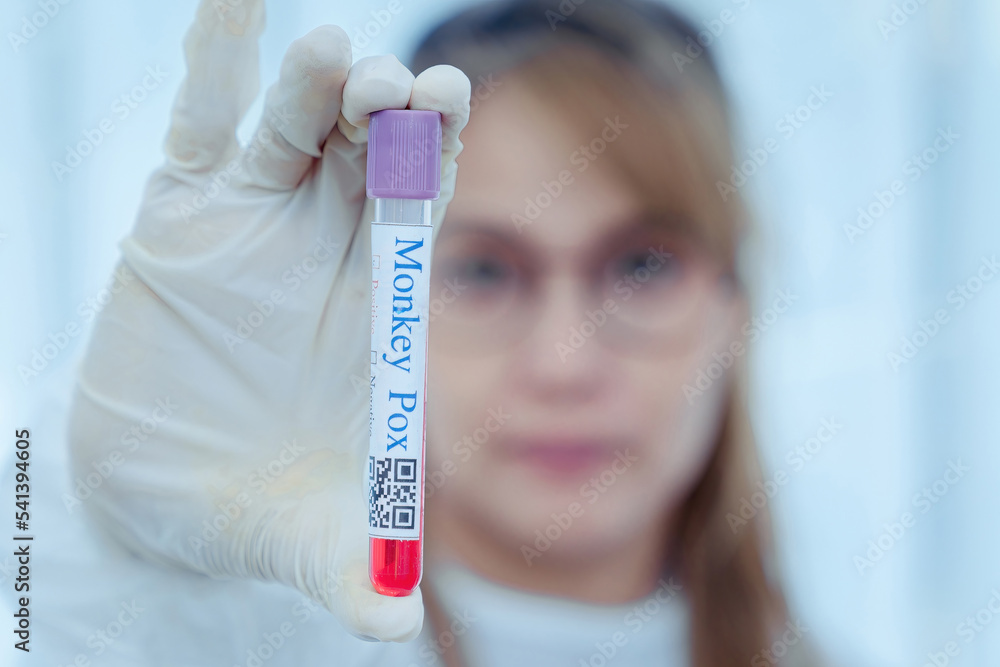 Monkey pox PCR test tube in doctors hand, medical worker in face mask ...