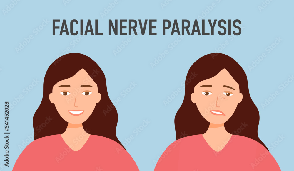 Poster Facial nerve paralysis concept vector illustration. Face palsy ...