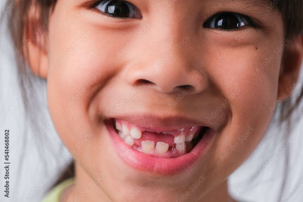 Portrait of an Asian girl with broken upper baby teeth and first ...