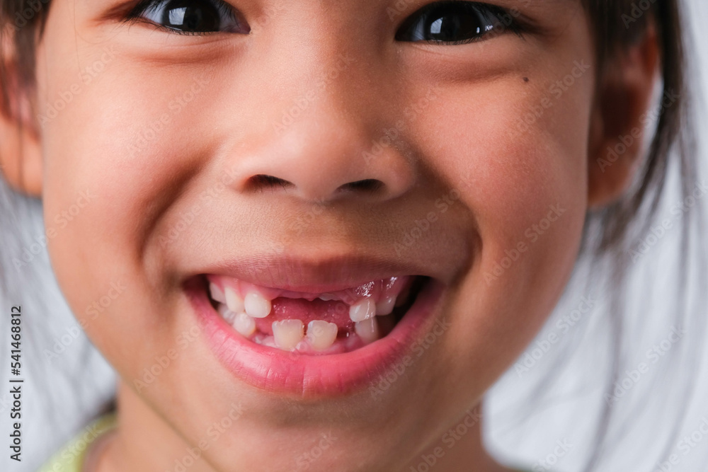 Portrait of an Asian girl with broken upper baby teeth and first ...
