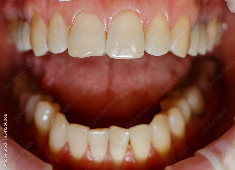 Human front teeth for prosthetics with ceramic veneers. Teeth before ...