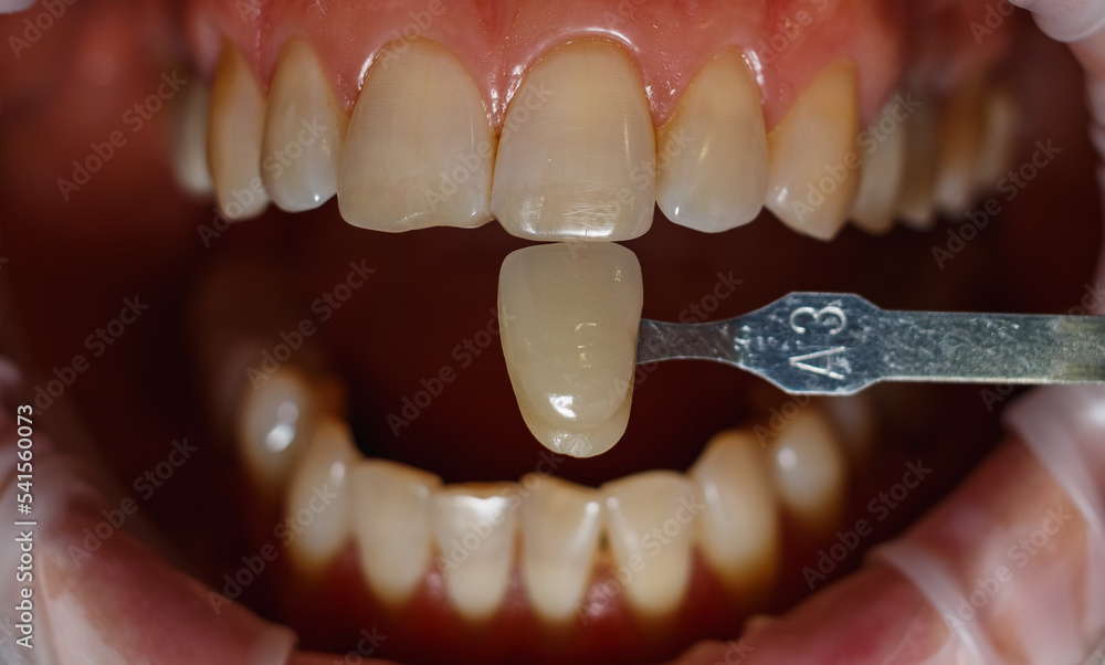 Determination of tooth color using a sample. Preparation for prosthetic ...